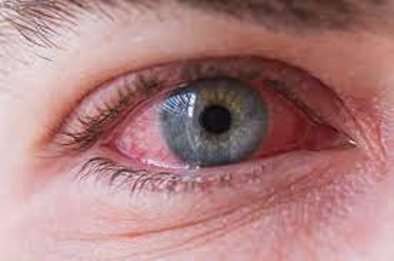Causes, Treatment, and Prevention of Pink Eye - Fareed Pharmacy